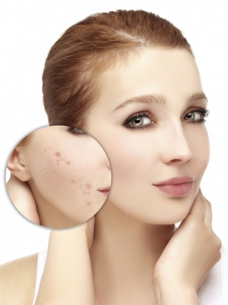 Granos rojos en el pecho: Por qué salen y cómo eliminarlos